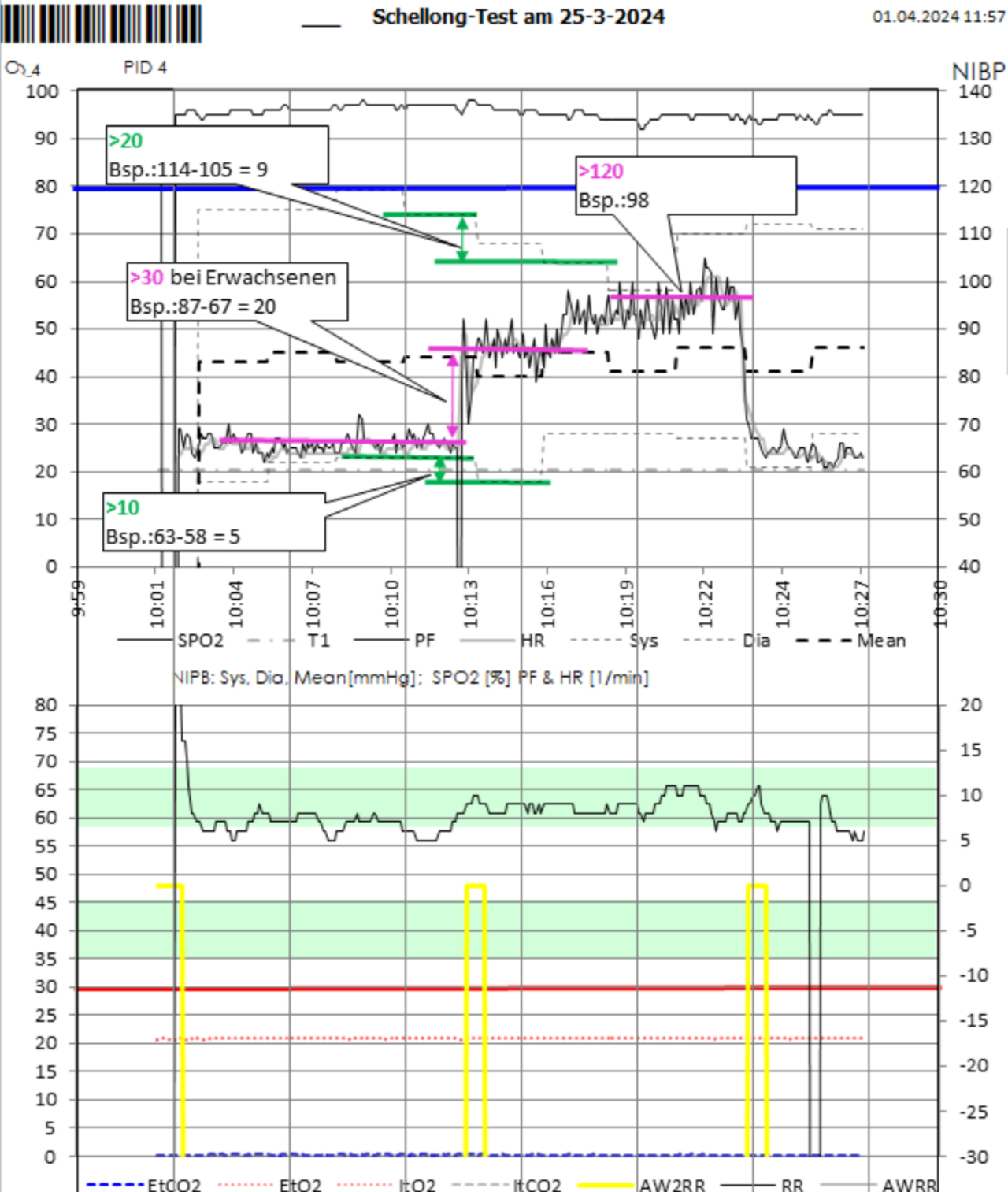 Schellong-Test bei ME CFS und Long Covid